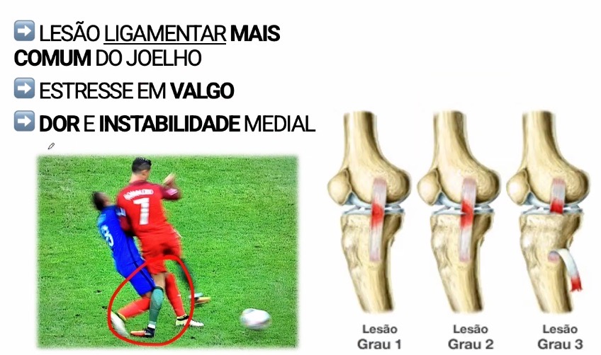 Ligamento Colateral Medial (LCM) - Dr. Daniel Bohn